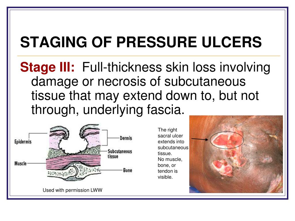 Ppt Pressure Ulcers Powerpoint Presentation Free Download Id 2776919