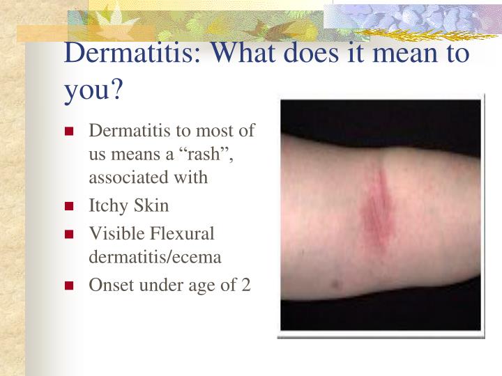 PPT - Rashes and the School Nurse PowerPoint Presentation - ID:2777002