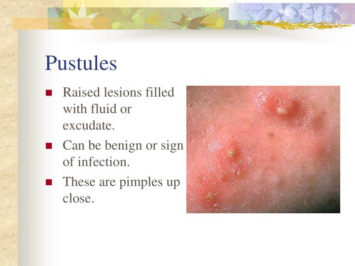 PPT - Rashes and the School Nurse PowerPoint Presentation - ID:2777002