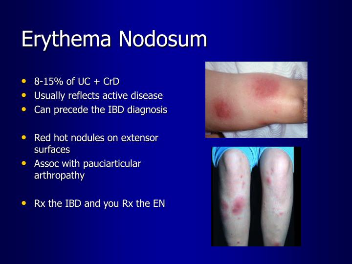 PPT - Extra GI Manifestations of IBD PowerPoint Presentation - ID:2777829