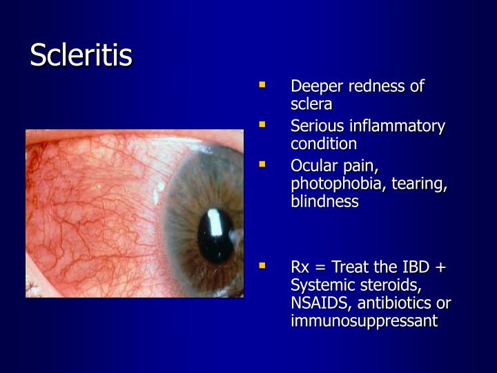 PPT - Extra GI Manifestations of IBD PowerPoint Presentation - ID:2777829
