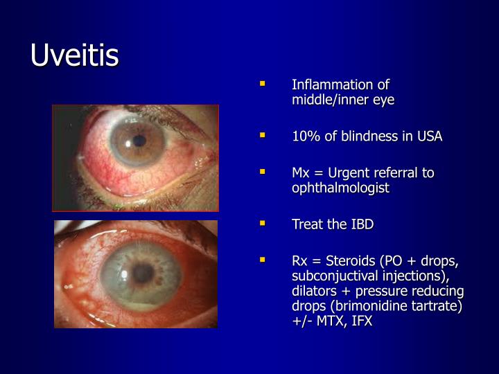 PPT - Extra GI Manifestations of IBD PowerPoint Presentation - ID:2777829