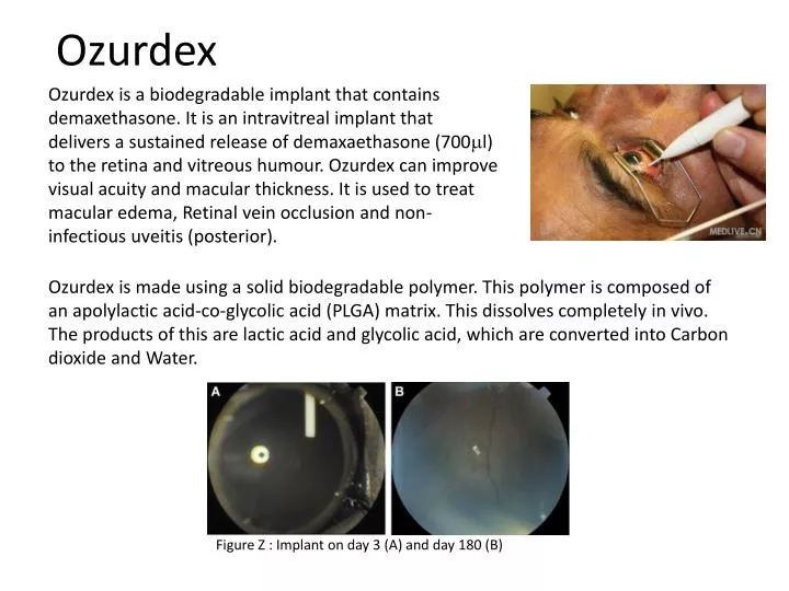 PPT - Ozurdex PowerPoint Presentation, free download - ID:2779997