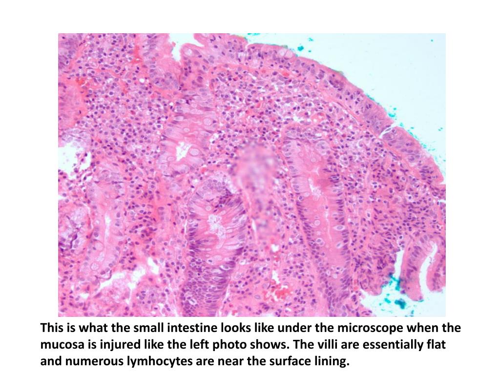 PPT - Case scenario: A 36 years old woman with chronic intermittent ...