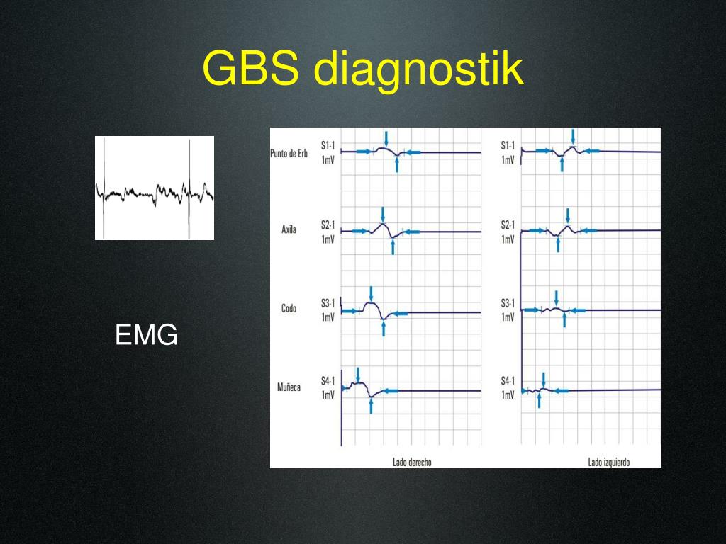 PPT - Albert Hietala, specialistläk, med dr Neurologen Sahlgrenska ...