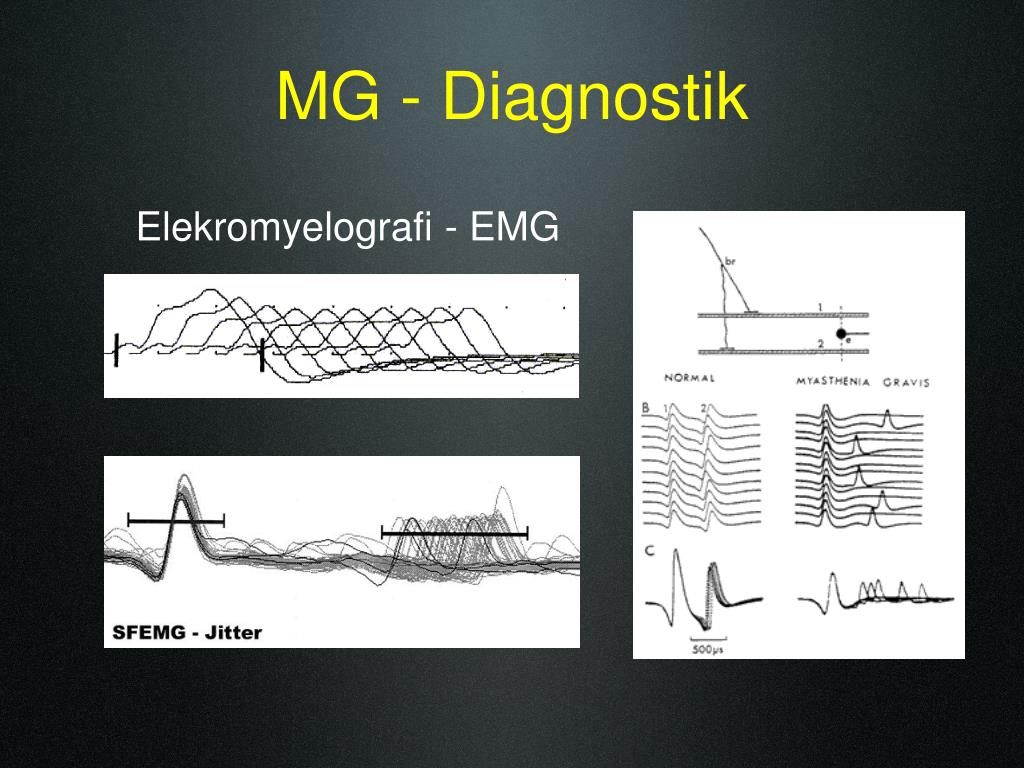 PPT - Albert Hietala, specialistläk, med dr Neurologen Sahlgrenska ...