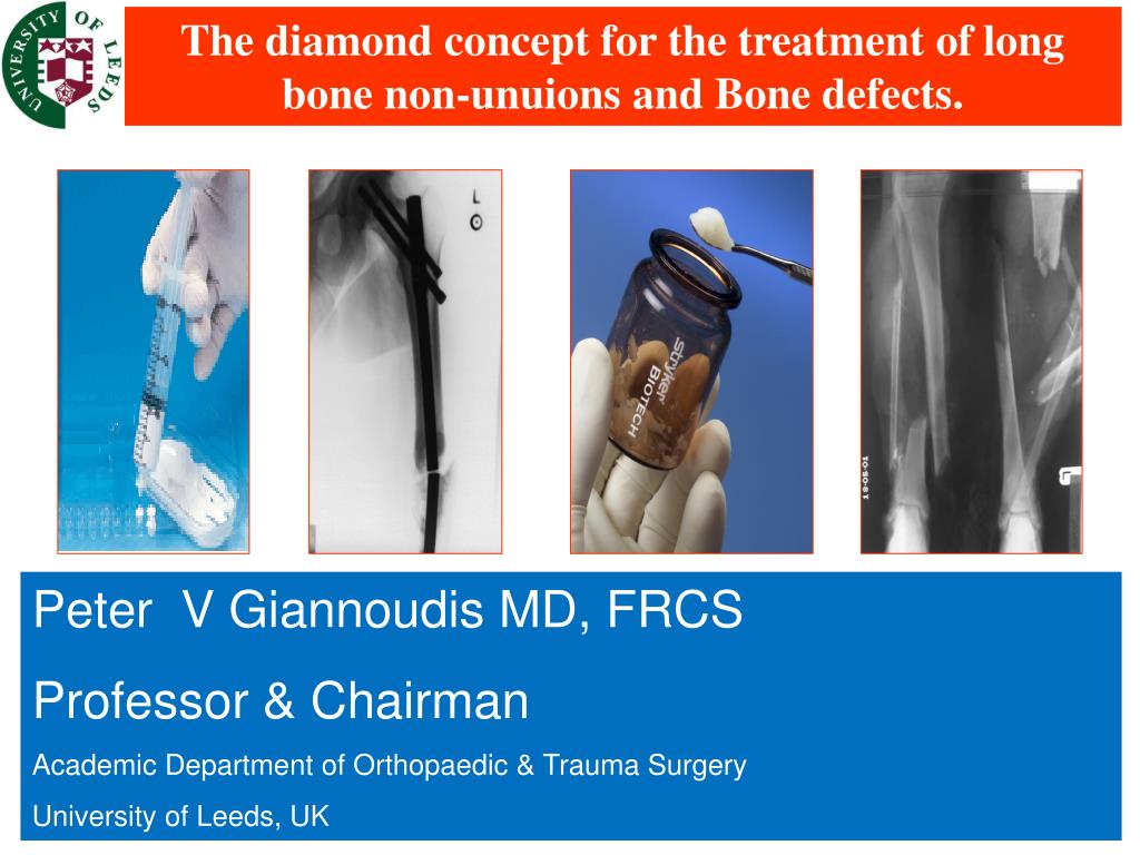 PPT - The diamond concept for the treatment of long bone non- unuions ...