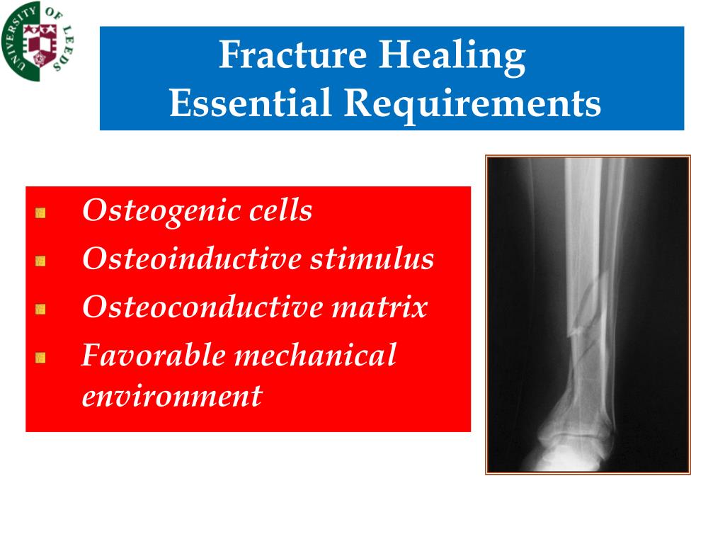 PPT - The diamond concept for the treatment of long bone non- unuions ...