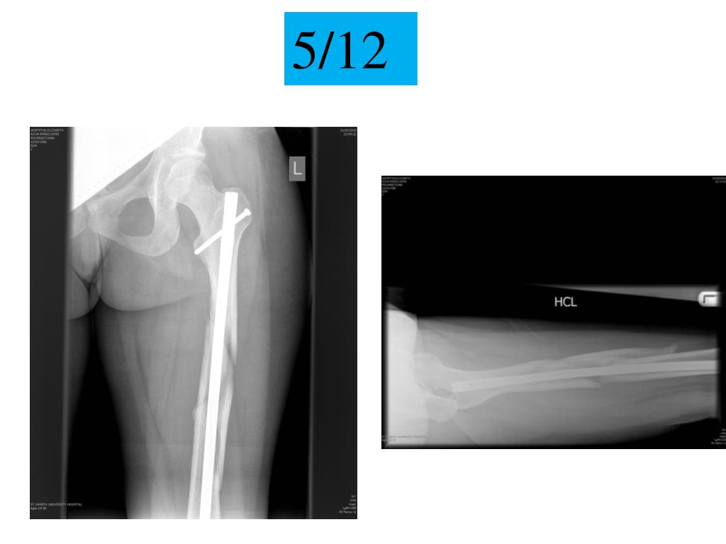 PPT - The diamond concept for the treatment of long bone non- unuions ...