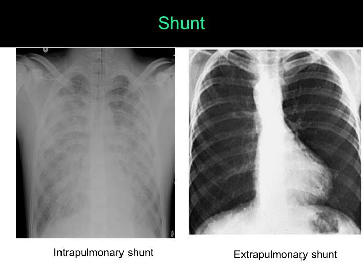 PPT - Arterial Blood Gas Interpretation PowerPoint Presentation - ID ...