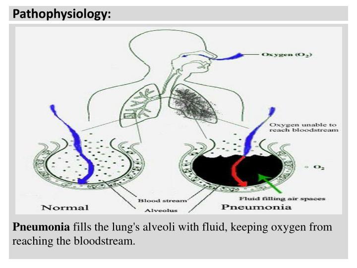 PPT - Pneumonia: PowerPoint Presentation - ID:2787113
