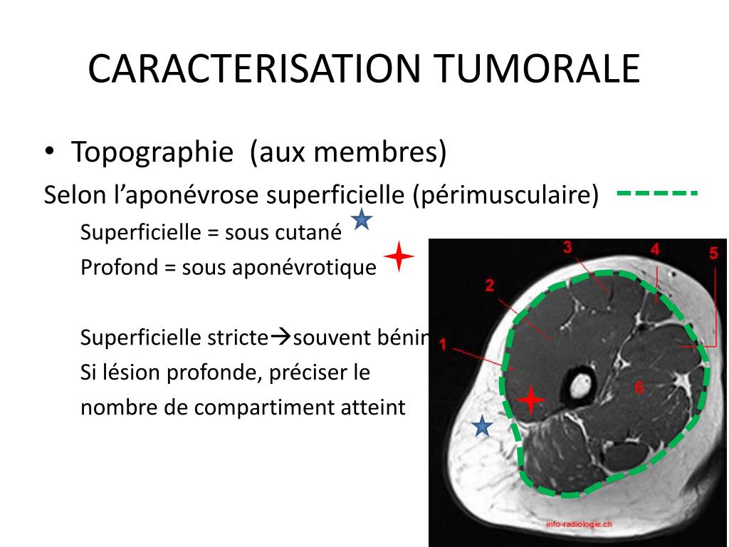 PPT - IMAGERIE DES SARCOMES DES TISSUS MOUS PowerPoint Presentation ...