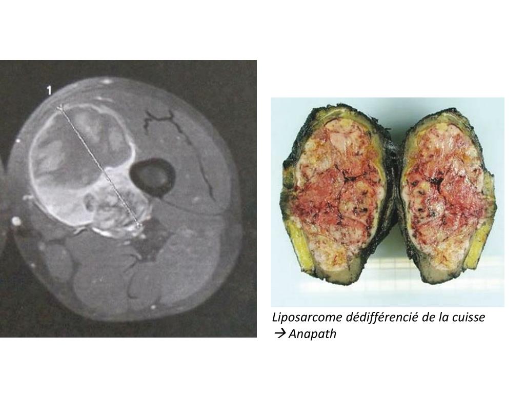 PPT - IMAGERIE DES SARCOMES DES TISSUS MOUS PowerPoint Presentation ...