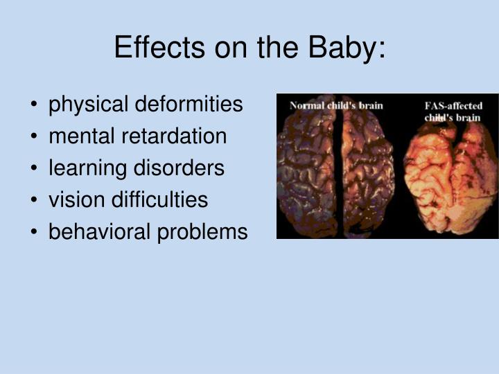 PPT - Fetal Alcohol Syndrome PowerPoint Presentation - ID:2798534