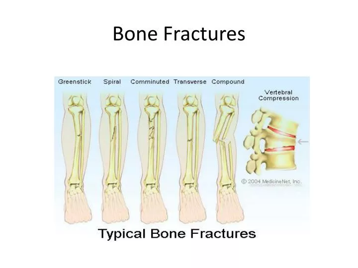 PPT - Bone Fractures PowerPoint Presentation, free download - ID:2807534