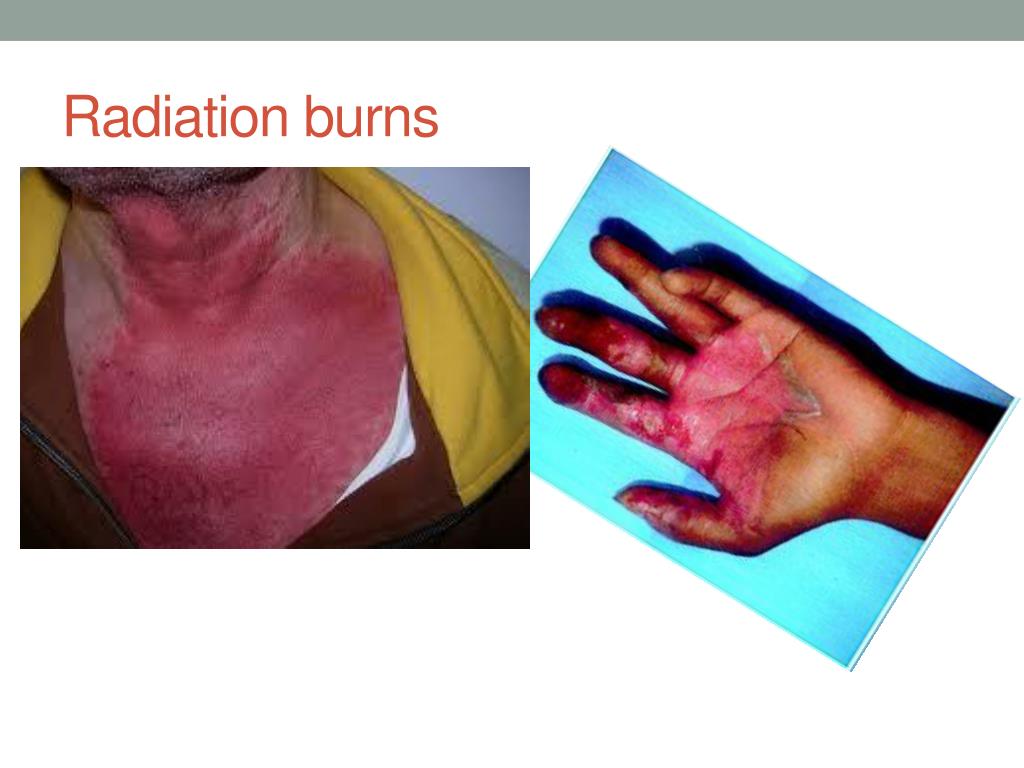 Beta Radiation Burns