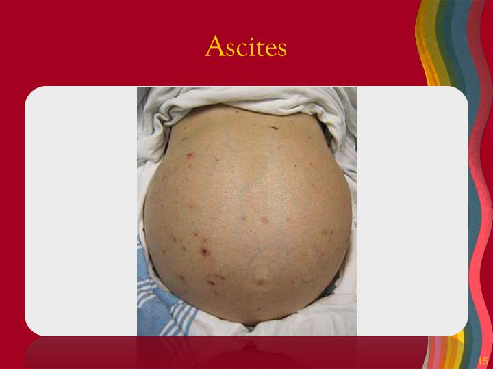 PPT - Cirrhosis of the Liver with Resulting Hepatic Encephalopathy ...