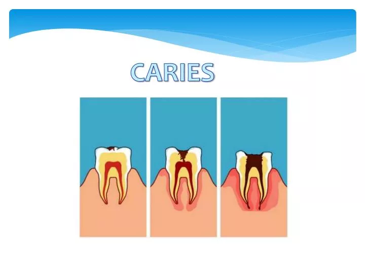 PPT - CARIES PowerPoint Presentation, free download - ID:2822168