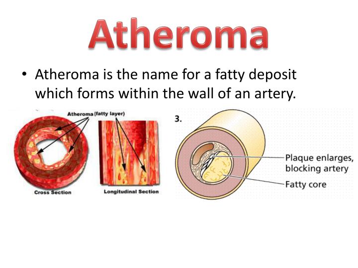 PPT - Heart disease – why worry? PowerPoint Presentation - ID:2822924
