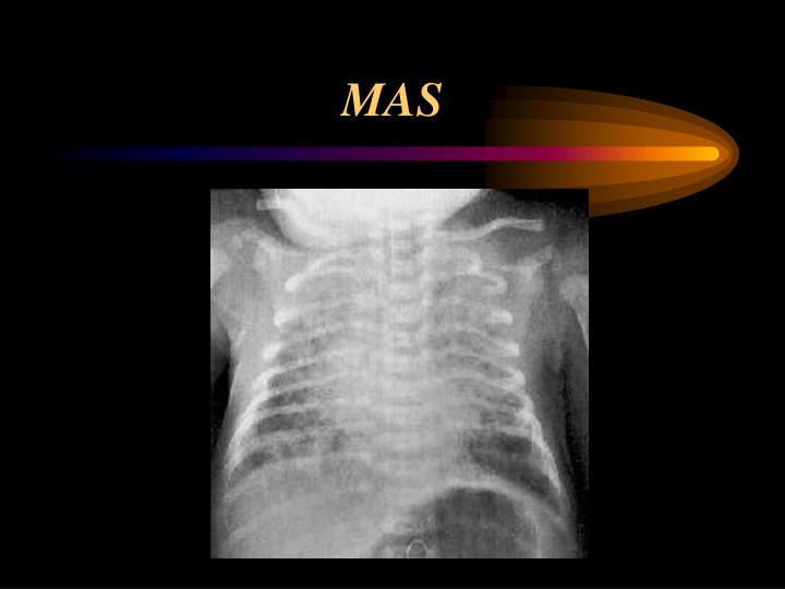 PPT - Reading a Neonatal Chest X-ray PowerPoint Presentation - ID:2827363