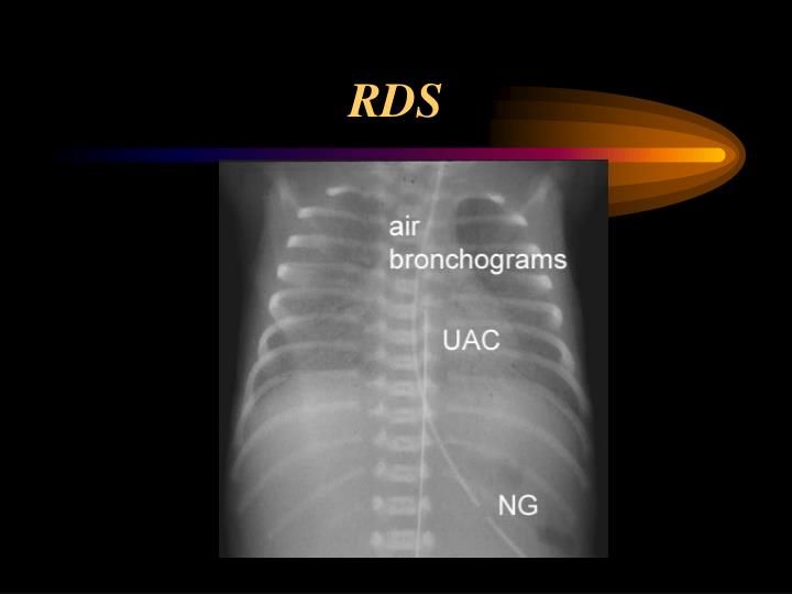 PPT - Reading a Neonatal Chest X-ray PowerPoint Presentation - ID:2827363