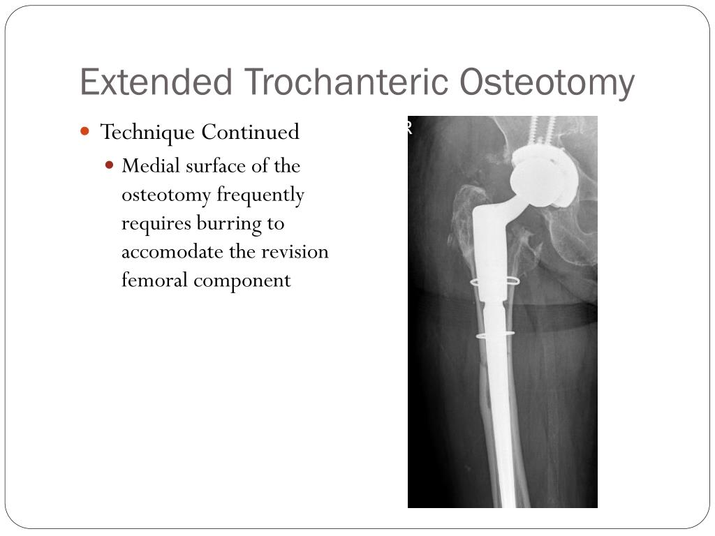 PPT - Exposure Options for Hip Revision: Trochanteric Osteotomies ...