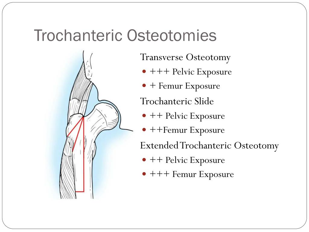 PPT - Exposure Options for Hip Revision: Trochanteric Osteotomies ...