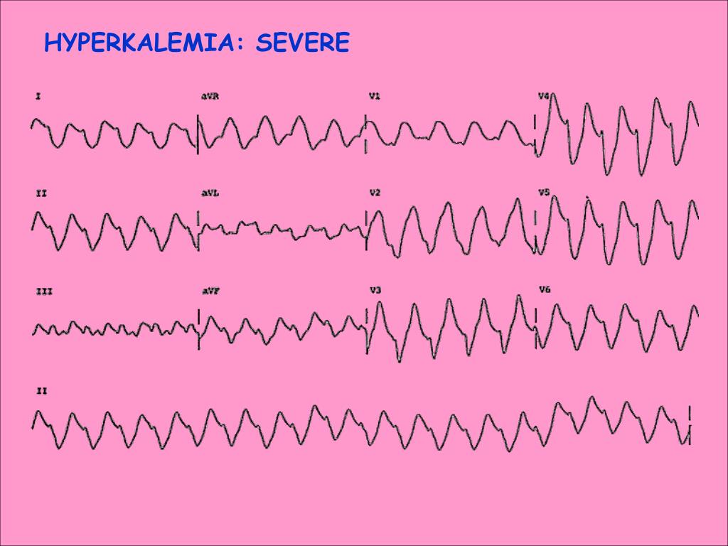 PPT - POTASSIUM: An Almond Joy a day means an ER stay PowerPoint ...