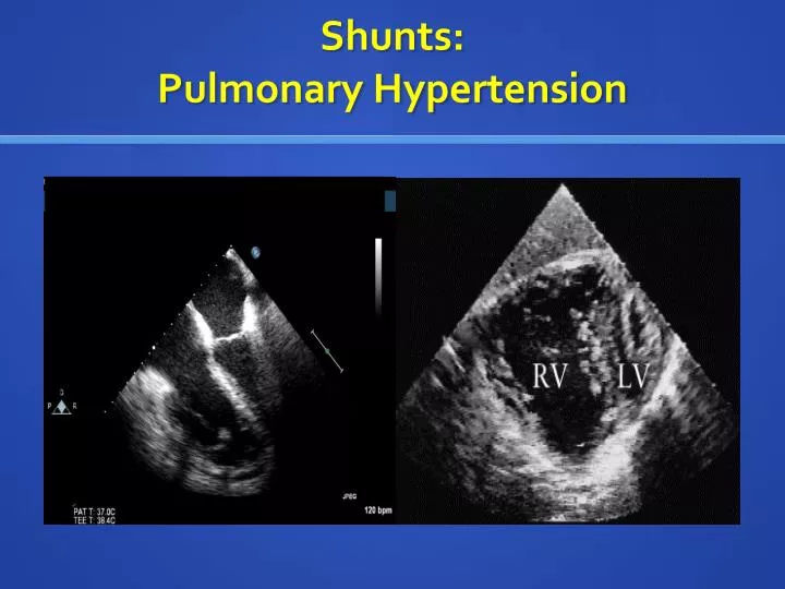 PPT - Shunts: Pulmonary Hypertension PowerPoint Presentation, free ...