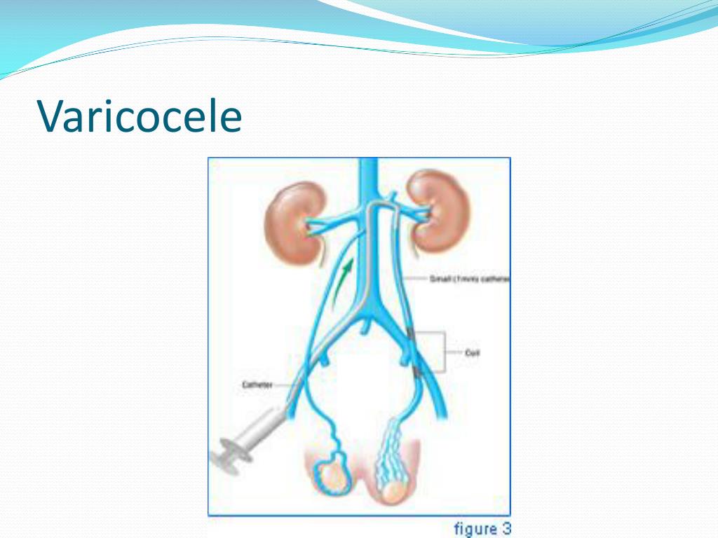 PPT - Patología benigna de cordón espermático y testículo PowerPoint ...