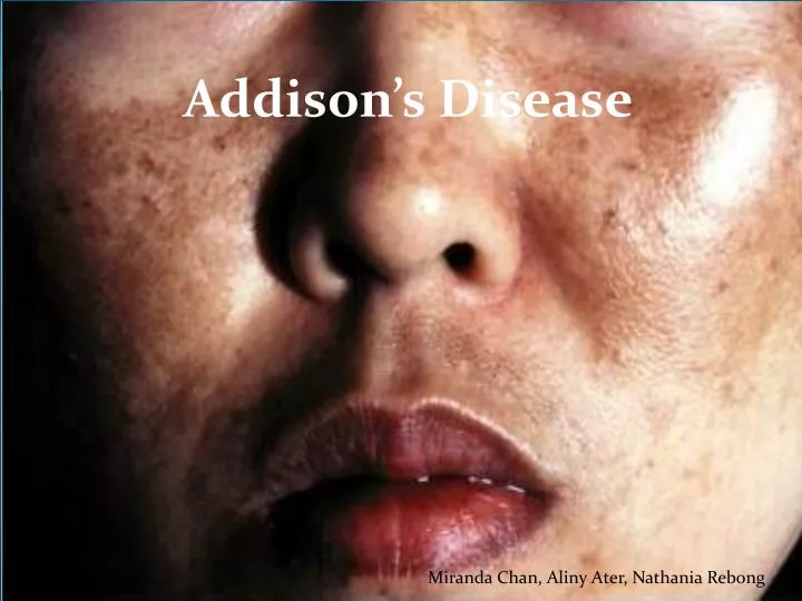 PPT - Addison’s Disease PowerPoint Presentation - ID:2843179