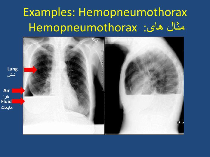PPT - Basics of Chest X-Ray PowerPoint Presentation - ID:2849435