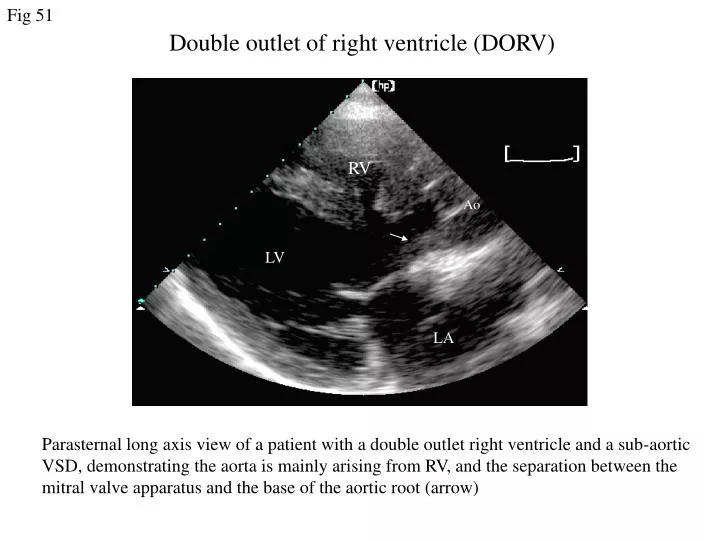 PPT - Double outlet of right ventricle (DORV) PowerPoint Presentation ...