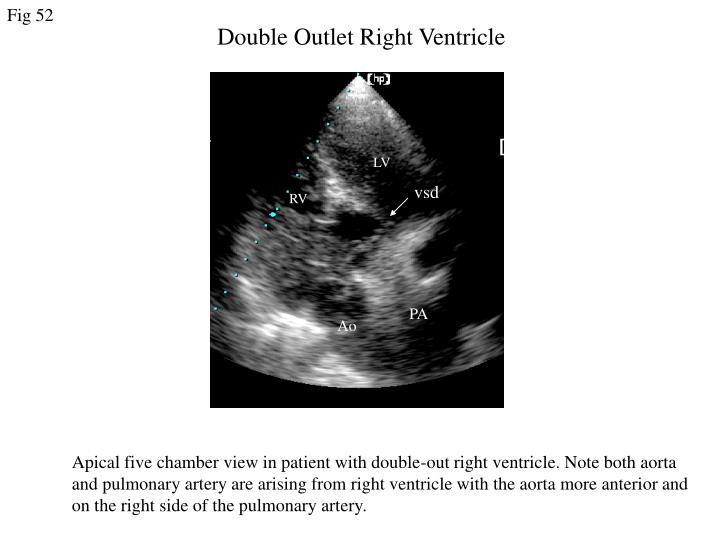 PPT - Double outlet of right ventricle (DORV) PowerPoint Presentation ...