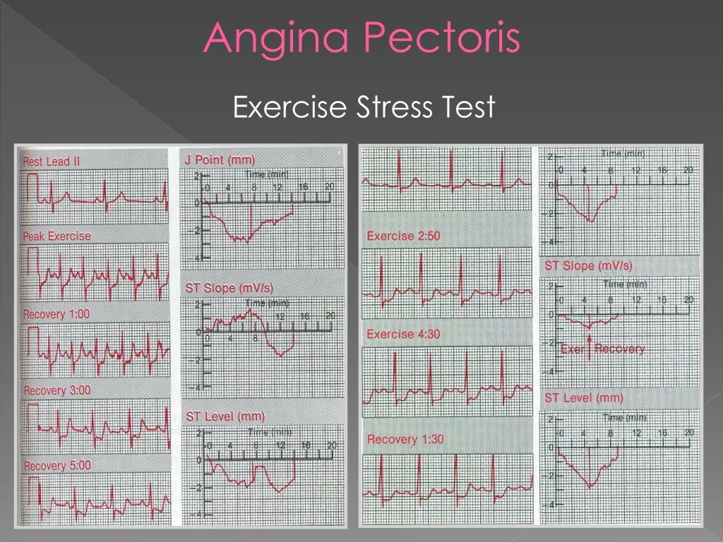 PPT - ISCHAEMIC HEART DISEASE Pathophysiology And Stable Angina ...