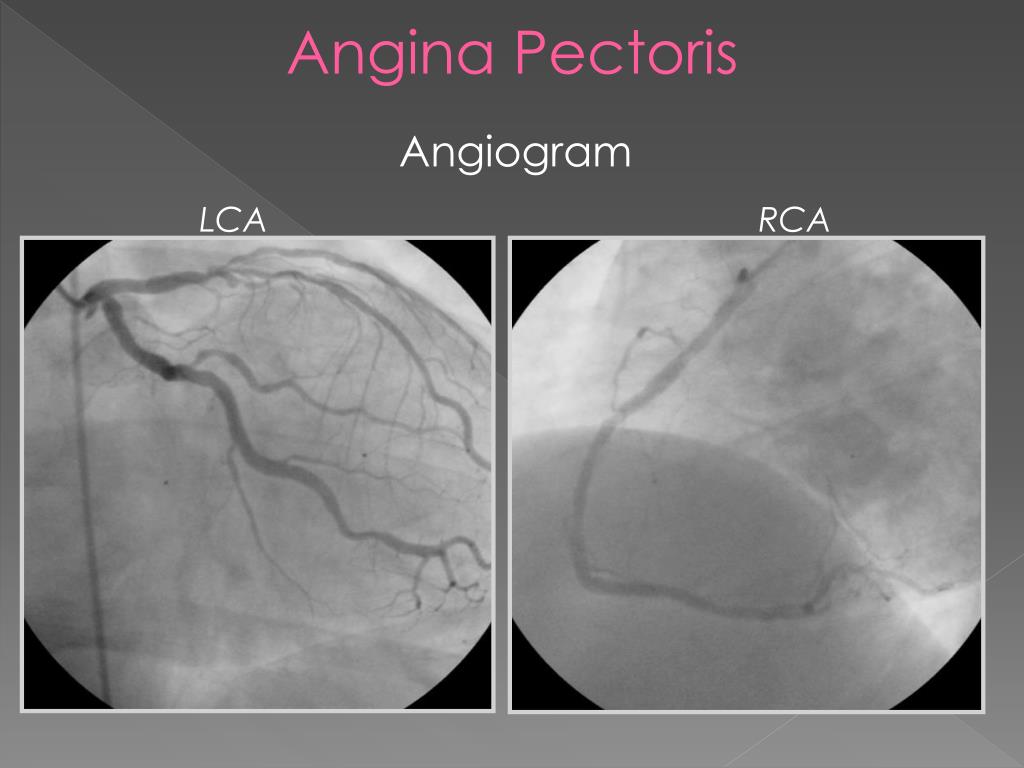 PPT - ISCHAEMIC HEART DISEASE Pathophysiology And Stable Angina ...