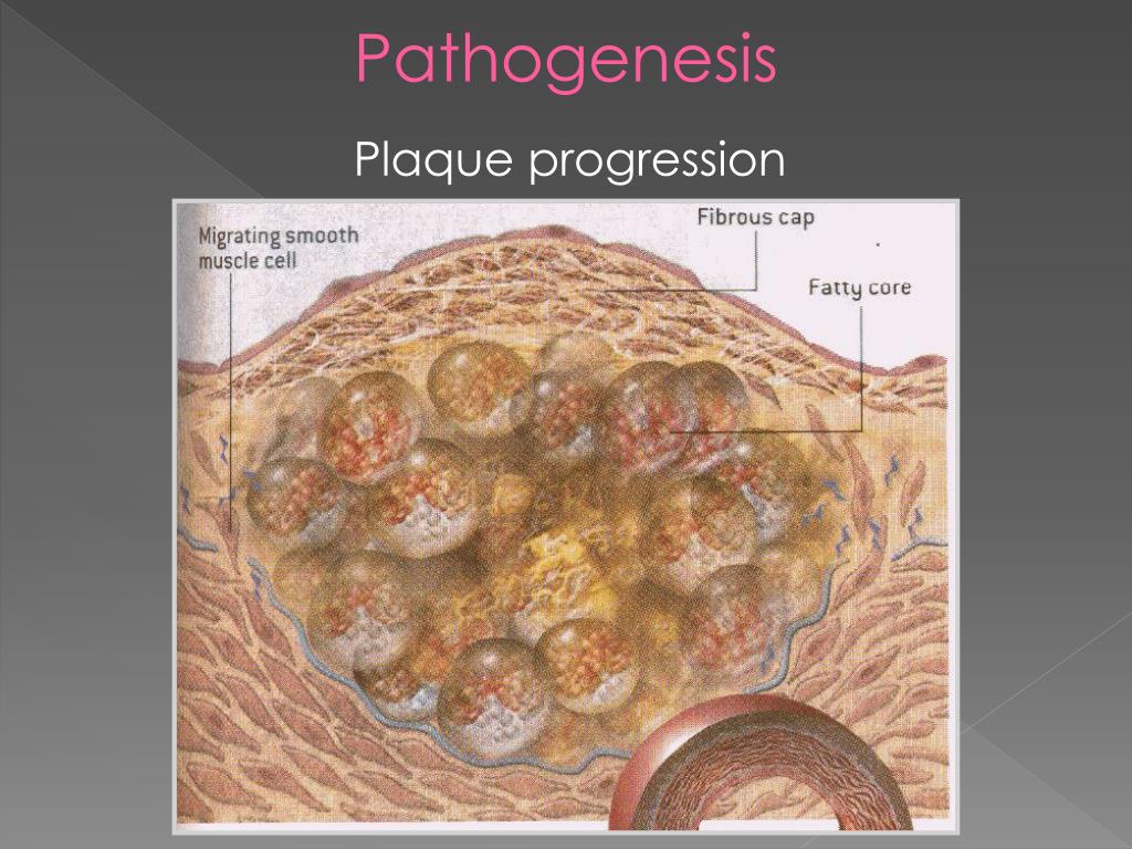 PPT - ISCHAEMIC HEART DISEASE Pathophysiology And Stable Angina ...