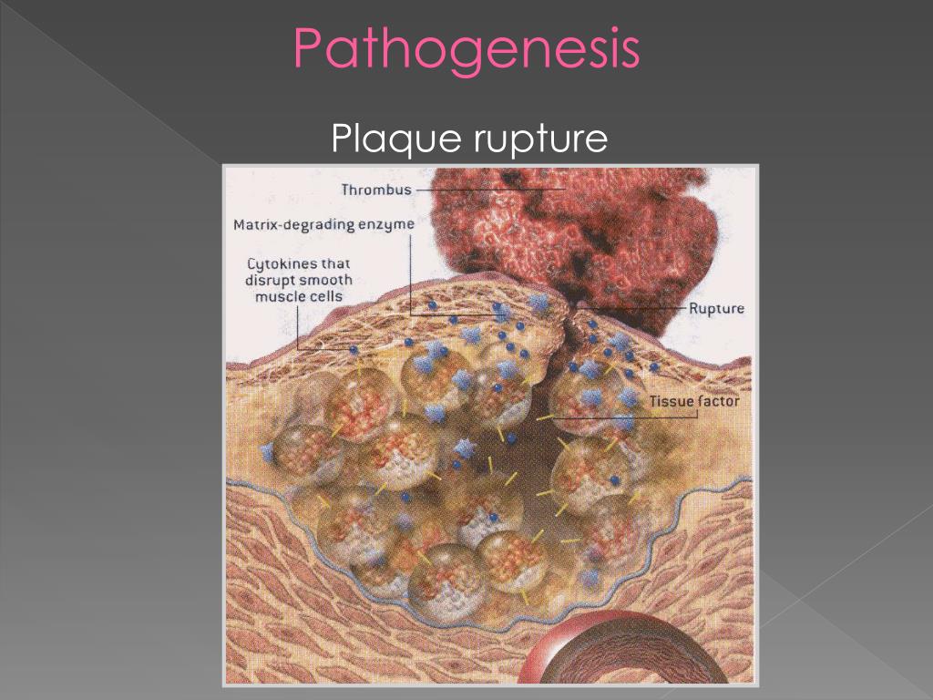 PPT - ISCHAEMIC HEART DISEASE Pathophysiology And Stable Angina ...