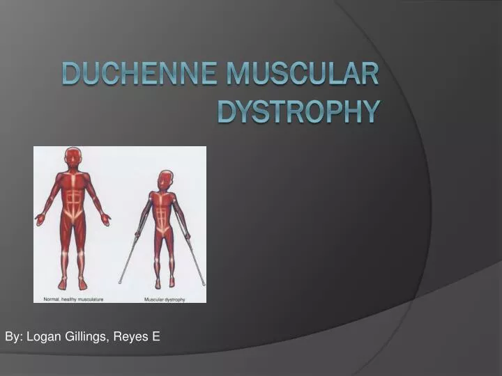 PPT - Duchenne Muscular dystrophy PowerPoint Presentation, free ...