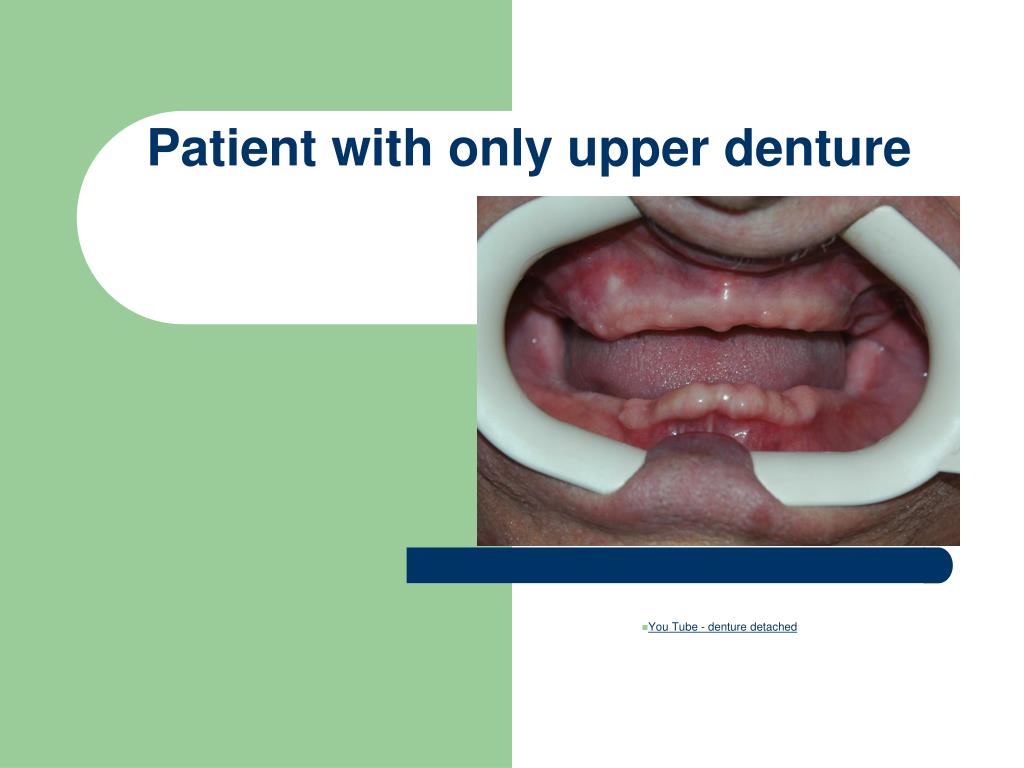PPT - Almitech Implant System for implant retained overdentures ...