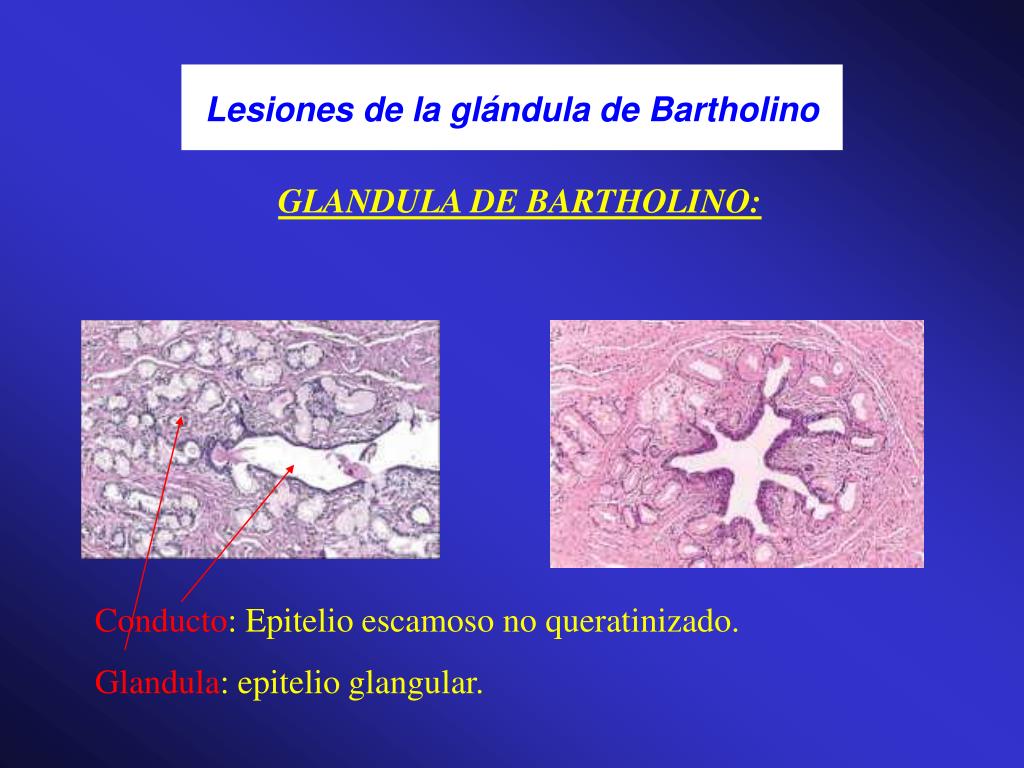 PPT - Lesiones de la glándula de Bartholino PowerPoint Presentation ...