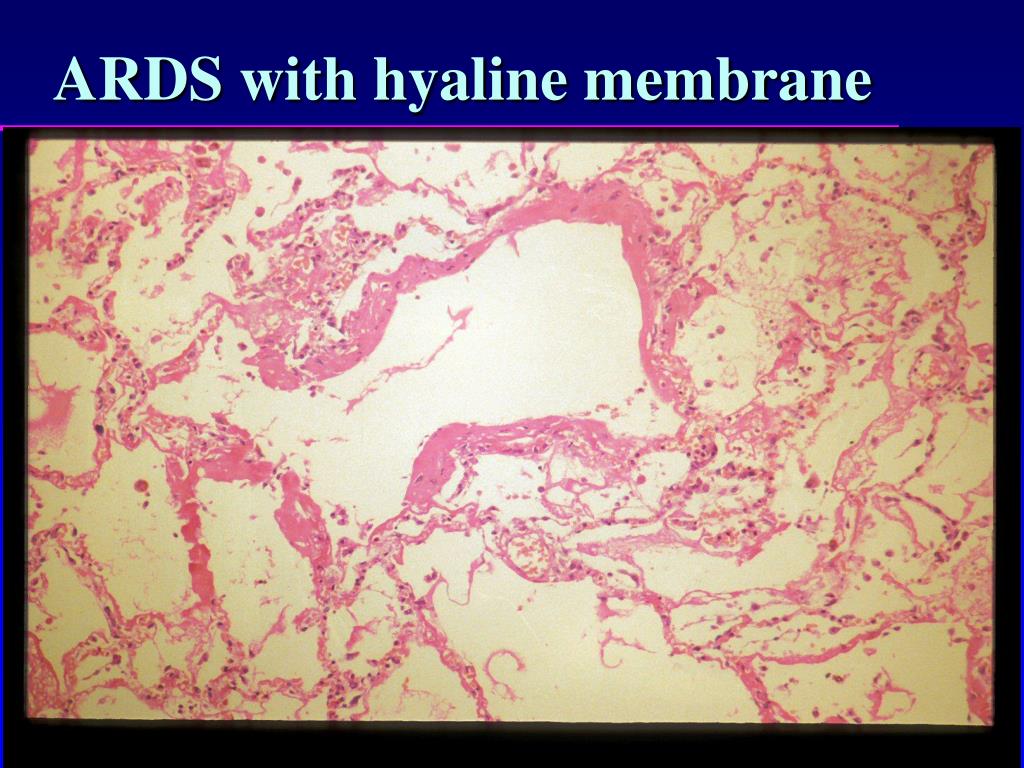 PPT - 1.Pulmonary Vascular Disease 2.Pleural Disease PowerPoint ...
