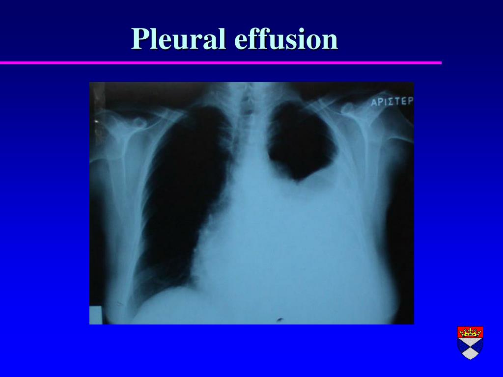 PPT - 1.Pulmonary Vascular Disease 2.Pleural Disease PowerPoint ...