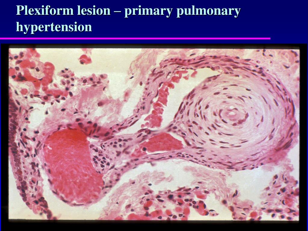 PPT - 1.Pulmonary Vascular Disease 2.Pleural Disease PowerPoint ...