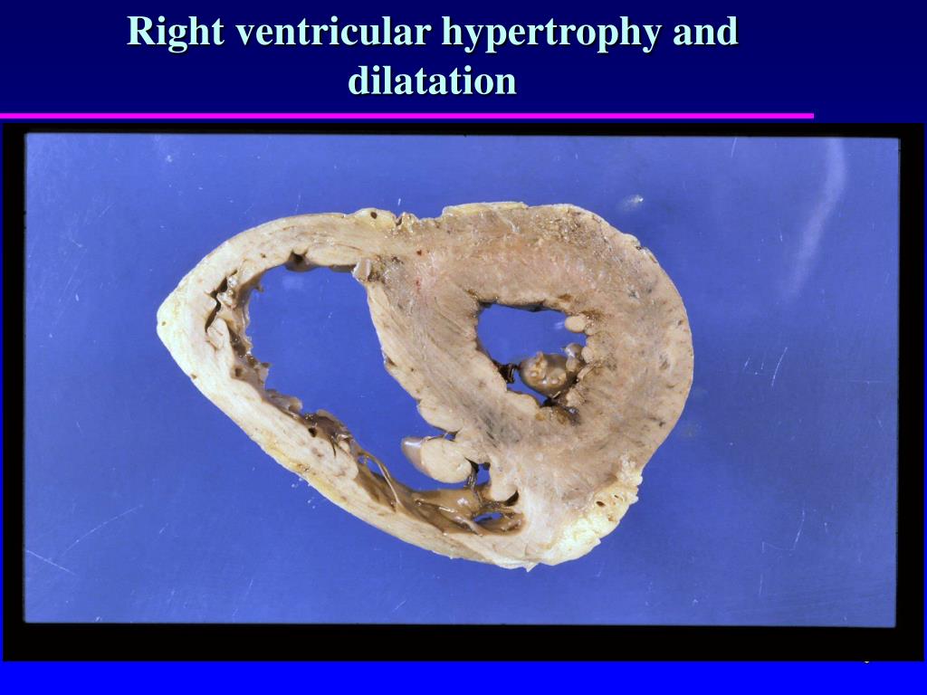 PPT - 1.Pulmonary Vascular Disease 2.Pleural Disease PowerPoint ...