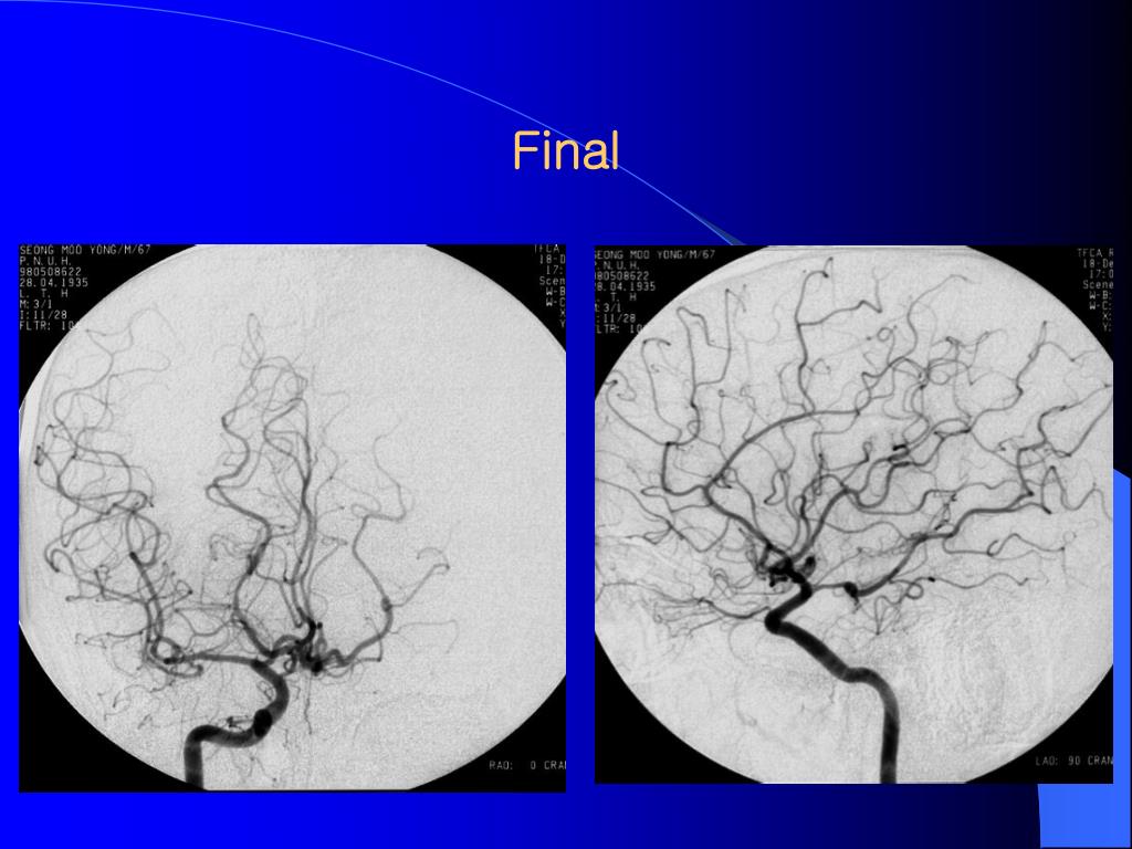 PPT - Coronary Stent Angioplast 를 통한 MCA Stenosis 의 치료 PowerPoint ...