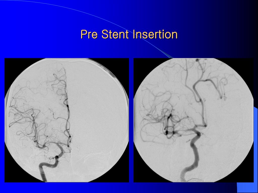 PPT - Coronary Stent Angioplast 를 통한 MCA Stenosis 의 치료 PowerPoint ...