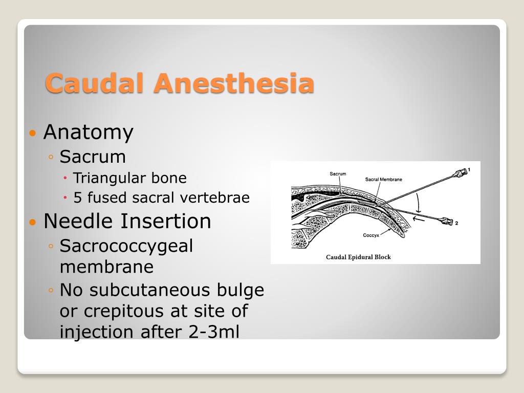 Caudal Anesthesia Technique