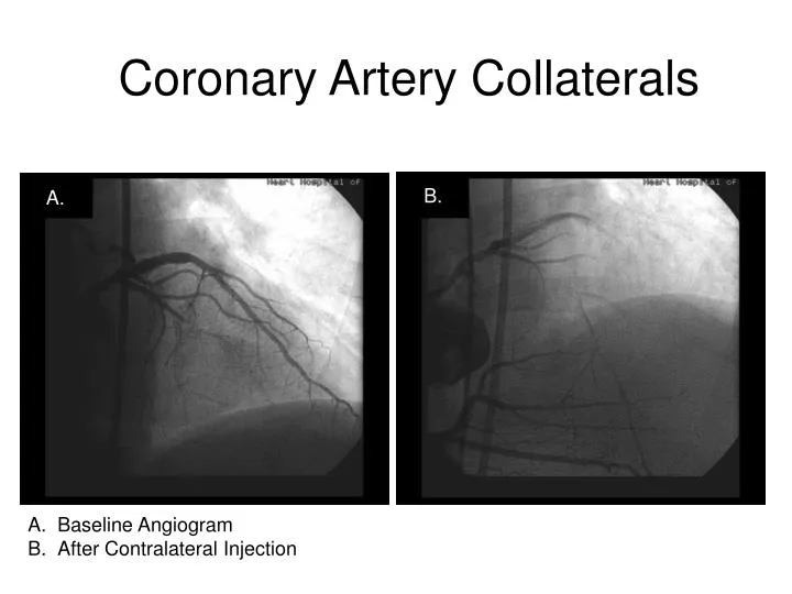 PPT - Coronary Artery Collaterals PowerPoint Presentation, free ...