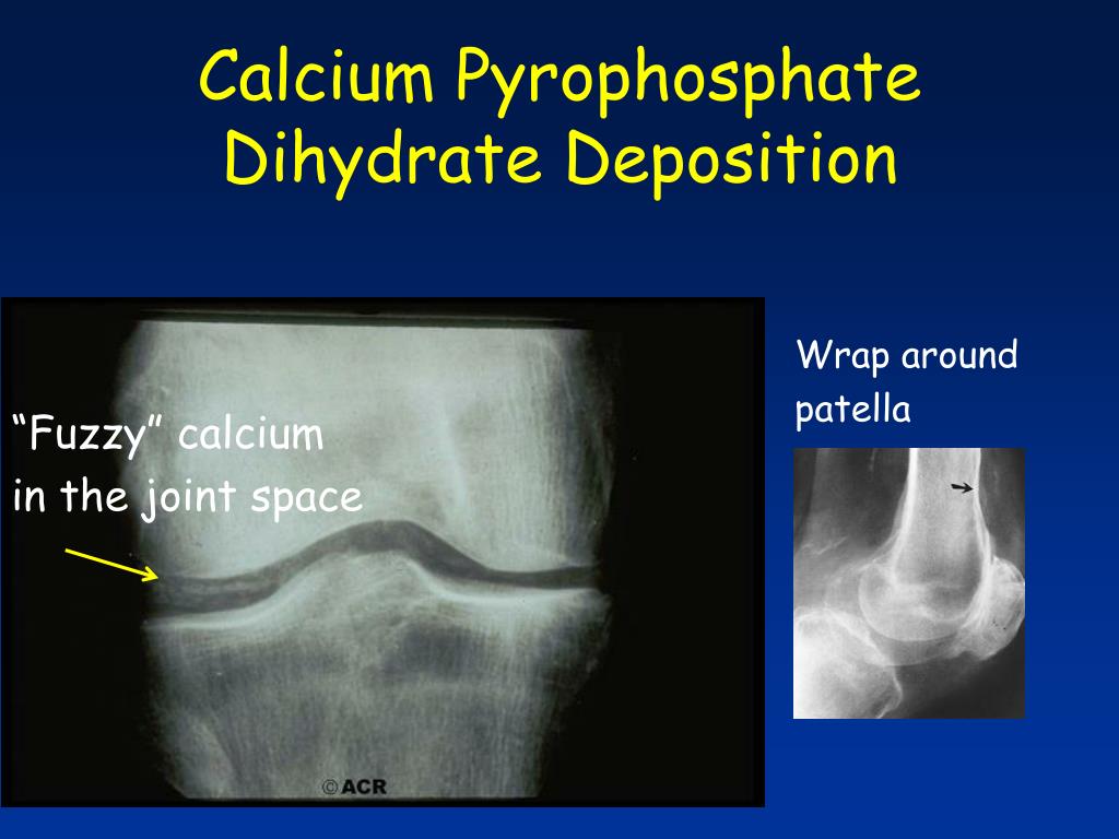 PPT - Crystal-induced arthritis & Osteoarthritis PowerPoint ...